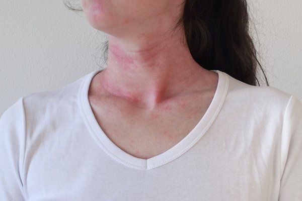 Type IV Allergic Reactions - Lindsey Elmore